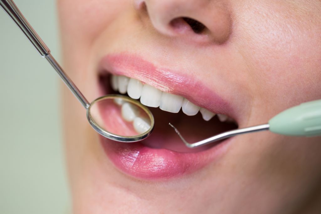 Bonded Fillings in SW Edmonton | Dental Fillings Near Me