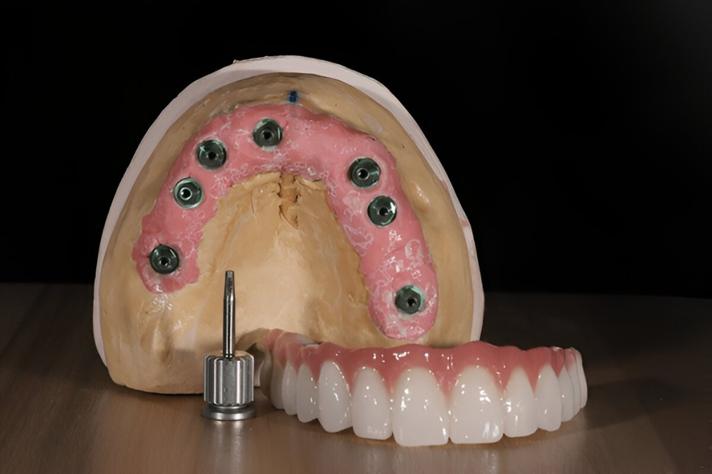 Bone Grafts in SW Edmonton | Bone Grafts Near Me