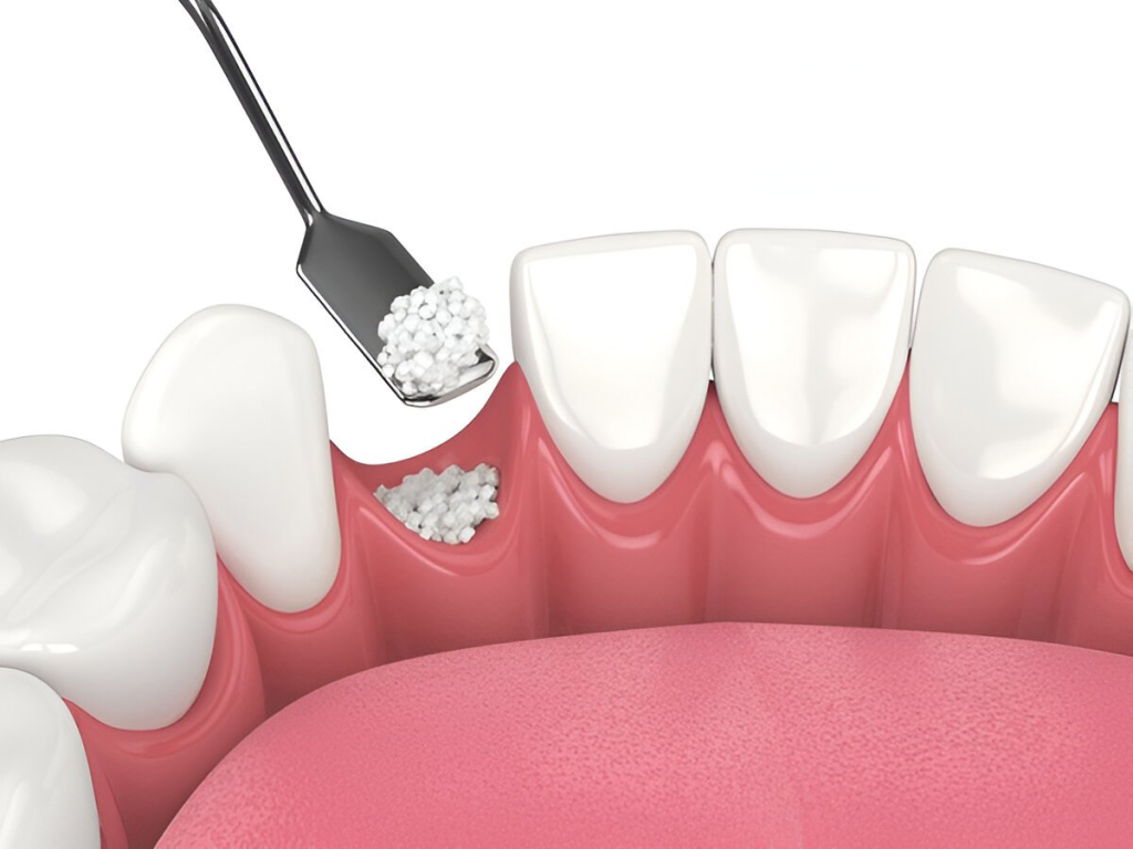 Bone Grafts in SW Edmonton | Bone Grafts Near Me
