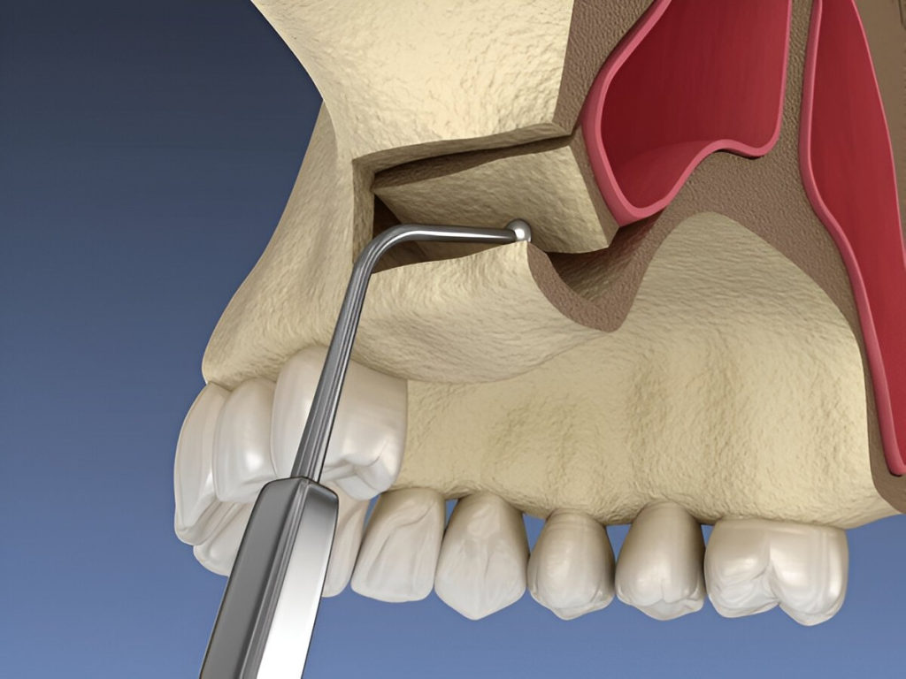 Sinus Lifts in SW Edmonton | Sinus Lifts Near Me