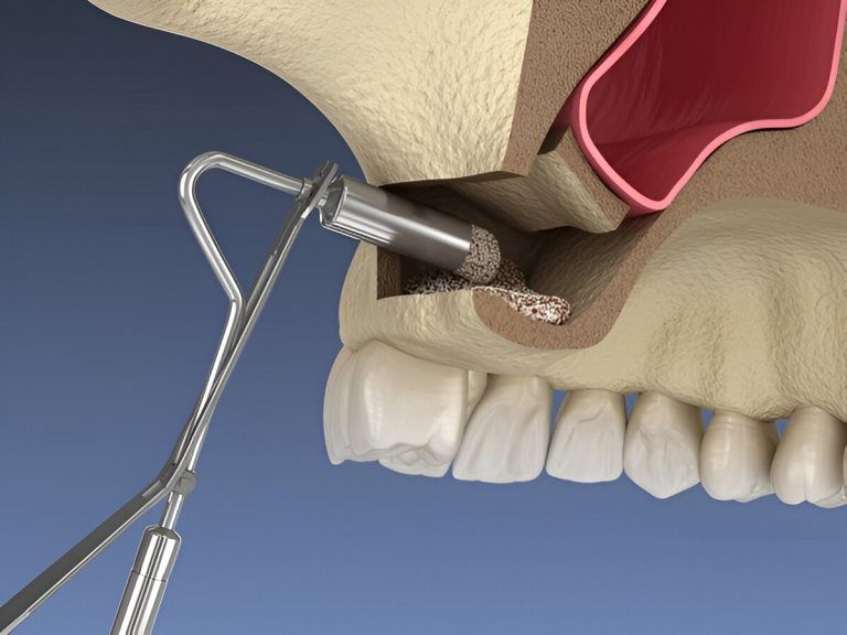 Sinus Lifts in SW Edmonton | Sinus Lifts Near Me
